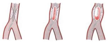 Dotterbehandeling (PCI) | Jeroen Bosch Ziekenhuis