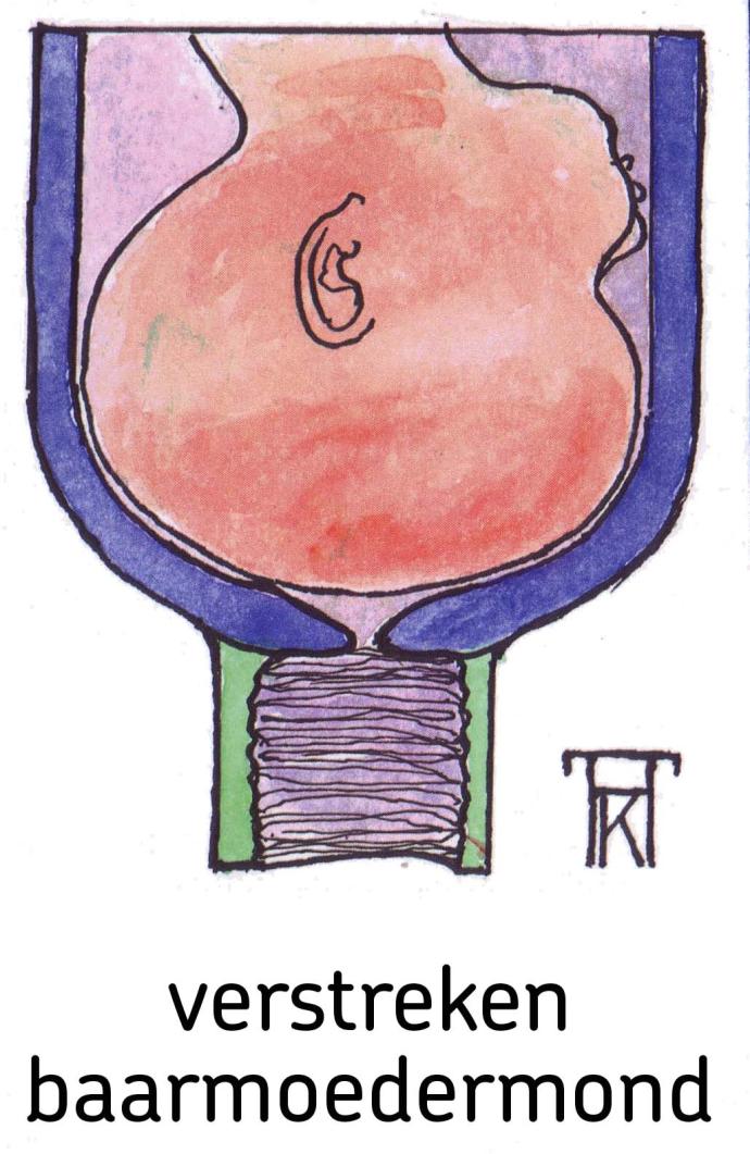 Inleiden van de bevalling | Jeroen Bosch Ziekenhuis